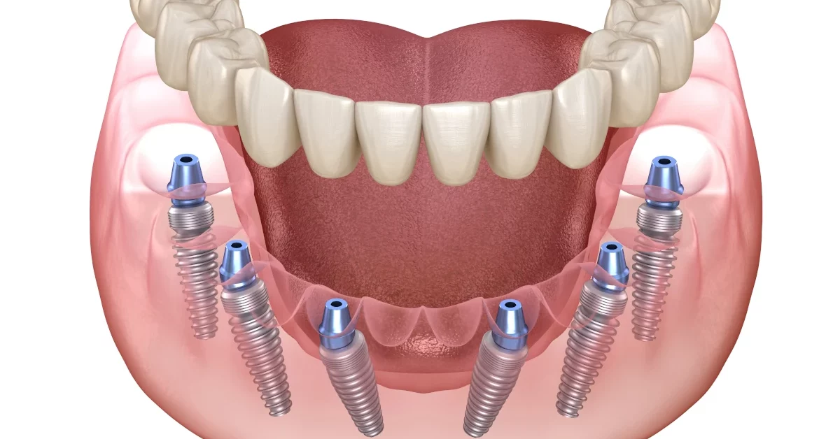 All-on-6 Dental Implants - All On Four Dental Implants